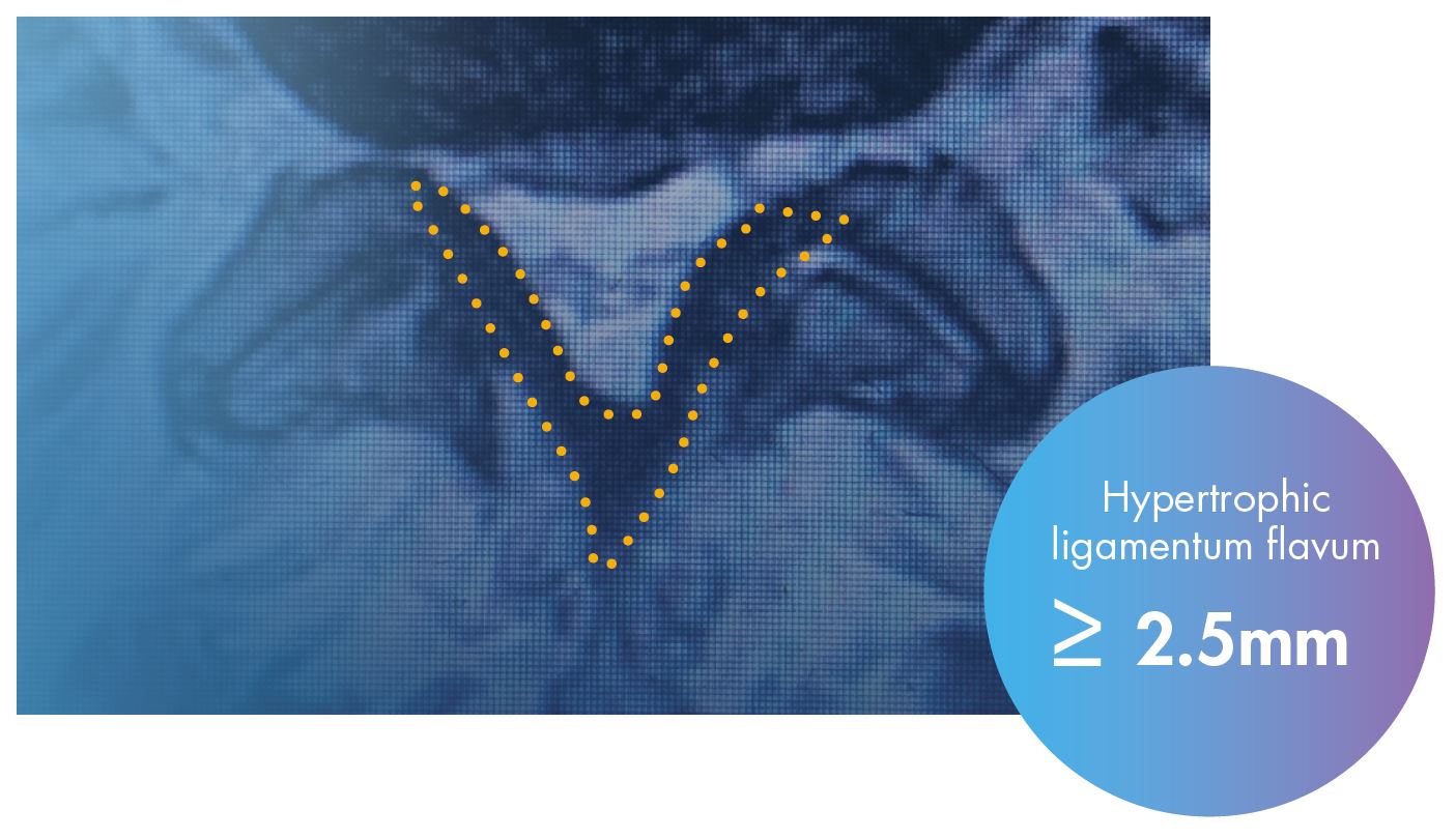Identifying & Educating mild® Patients – APP Guidance | Vertos